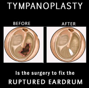 Best Ear Surgery in Nagpur - Tympanoplasty Surgery in Nagpur